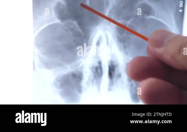 An X-ray of the maxillary sinuses is studied. Inflammation of the ...