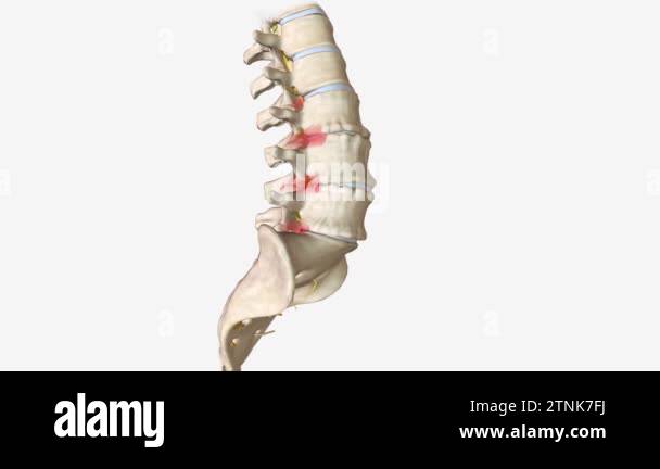 Degenerative disc disease isn't actually a disease, but rather a ...