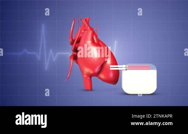 Cardiac pacemaker Stock Videos & Footage - HD and 4K Video Clips - Alamy