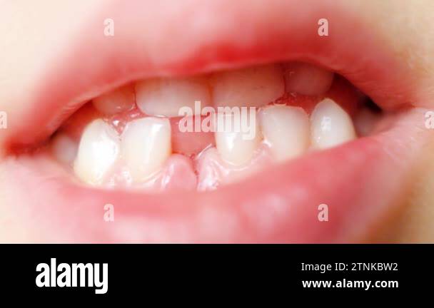 Loss of milk teeth in children. A six-year-old child shows the first ...