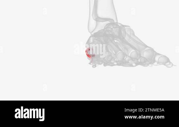 The abductor digiti minimi is a muscle which lies along the lateral ...