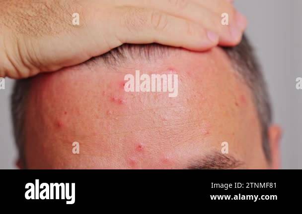 Man's forehead with acne, red spots, skin disease. Varicella or Herpes Zoster concept Stock ...