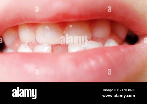 Loss of milk teeth in children. A six-year-old child shows the first ...