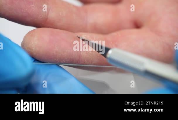 Assistant taking sample of patient cracked skin of fingers for ...