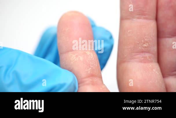Dry hands peeling of skin on hands and fingers. Chemical allergy ...