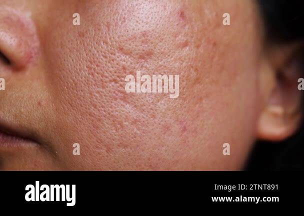 acne scars on the cheek on the face of women the reason for this is ...