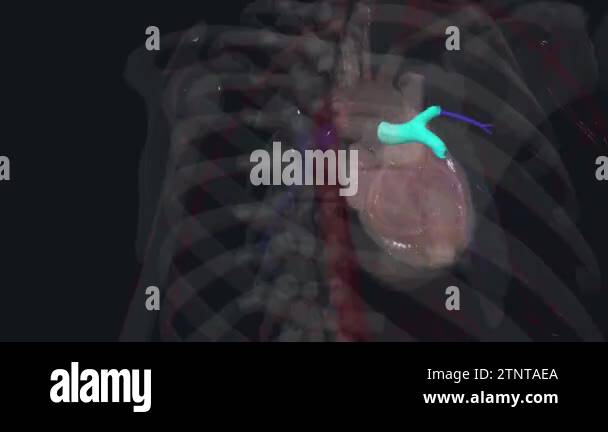 The right pulmonary artery courses posterior to the ascending aorta and ...