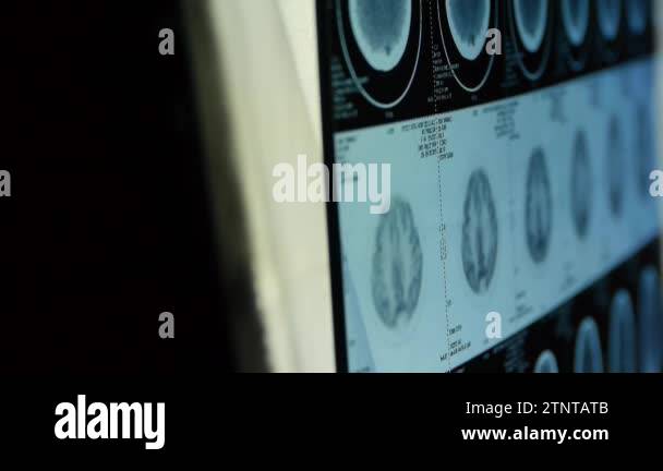 doctor study head pet/ct scan for analysis the disease,skull brain X ...