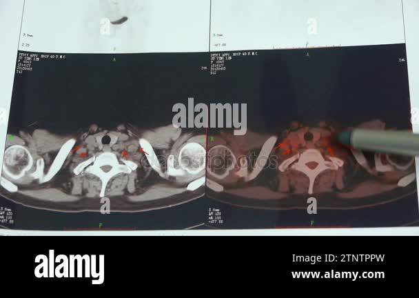 doctor study color clavicle pet-ct scan,lymph nodes X-ray,Cancer ...