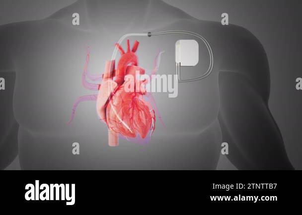 Implanted pacemaker Stock Videos & Footage - HD and 4K Video Clips - Alamy