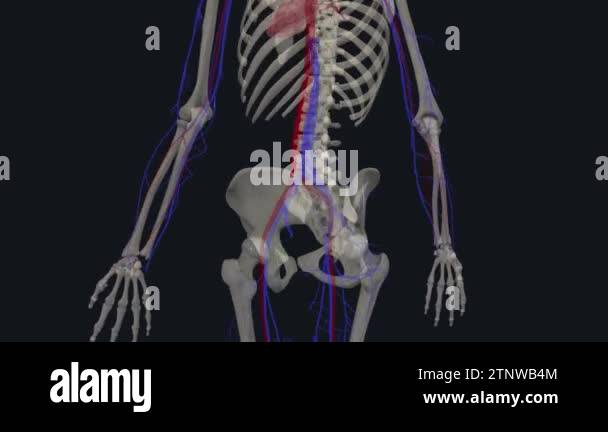 An abdominal aortic aneurysm is an enlarged area in the lower part of ...
