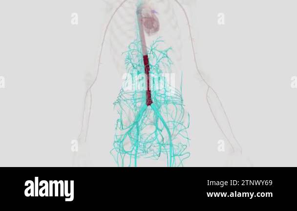 An abdominal aortic aneurysm is an enlarged area in the lower part of ...