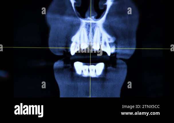 toothache symptom. X-ray of the human jaw on the computer. The doctor ...