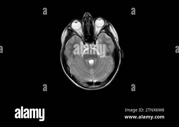 Magnetic resonance imaging(MRI) brain scan of a healthy 10 year old boy ...