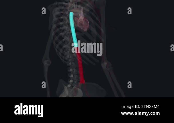 An abdominal aortic aneurysm is an enlarged area in the lower part of ...