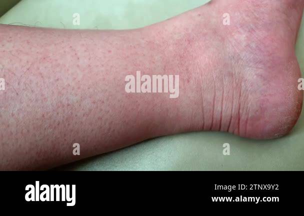 Red blood rash spots on skin dengue fever symptom mosquito tropical ...