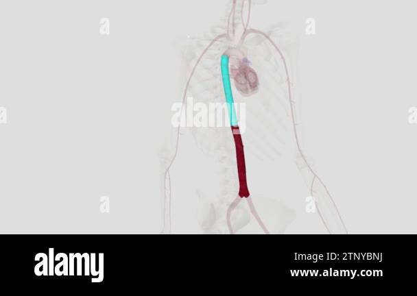 An abdominal aortic aneurysm is an enlarged area in the lower part of ...