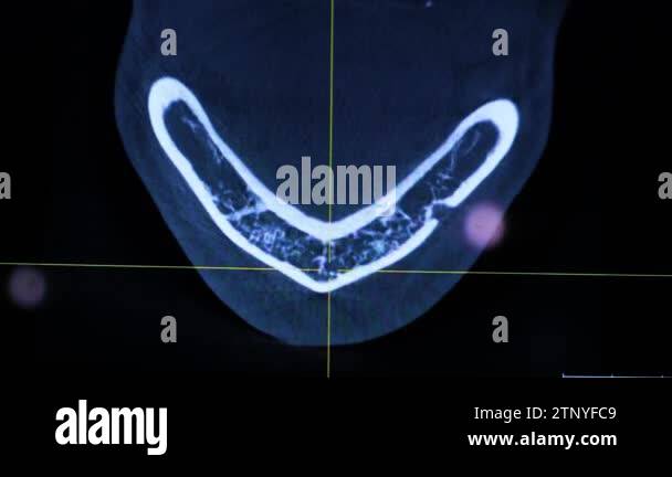 toothache symptom. X-ray of the human jaw on the computer. The doctor ...