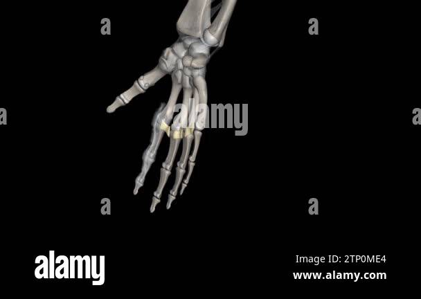 The deep transverse metacarpal ligament connects the palmar surfaces of ...