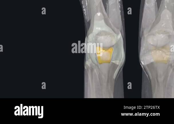 The knee is the largest and most complex joint in the body, holding ...