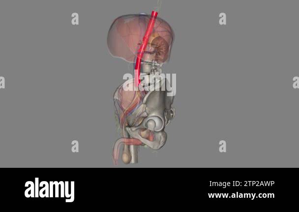 An abdominal aortic aneurysm is an enlarged area in the lower part of ...