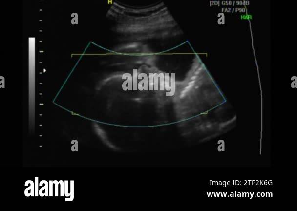 2D and 3D ultrasound of a beautiful baby at 23 weeks gestation Stock ...