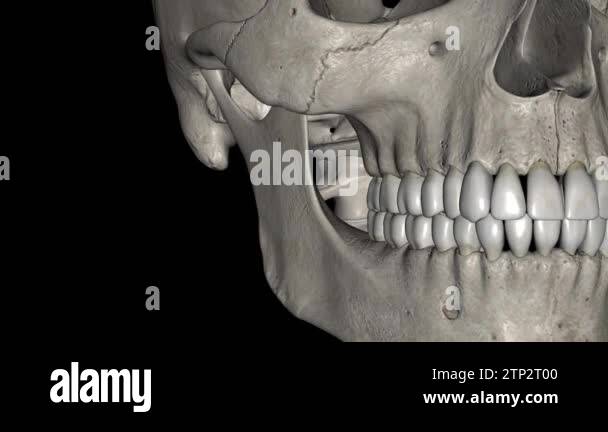 The sphenomandibular ligament (internal lateral ligament) is one of the ...
