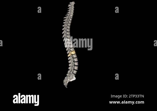 Thoracic Vertebral, T12 Twelve vertebrae are located in the thoracic ...