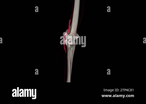 The popliteal artery is one of the major arteries of the leg. It is a ...
