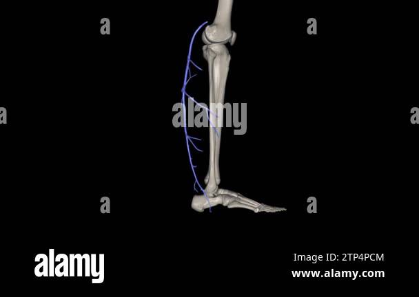The Small Saphenous Vein (SSV) is a superficial vein of the posterior ...
