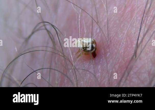 Bees venom sac. Honey bee stings a mans arm. When the sting is over ...