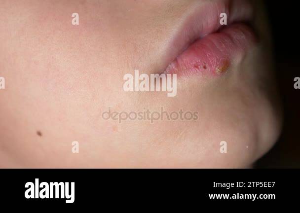 herpes on the lips of a boy. herpes. lip treatment. 4k, slow-motion ...