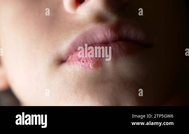 herpes on the lips of a boy. herpes. lip treatment. 4k, slow-motion ...