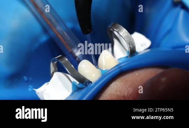 Dental process of cleaning teeth in patient mouth. Clean your teeth ...
