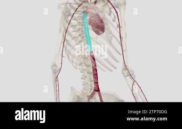 An abdominal aortic aneurysm is an enlarged area in the lower part of ...