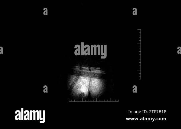 MRI scans of the cervical spine human body. Examining and identifying ...