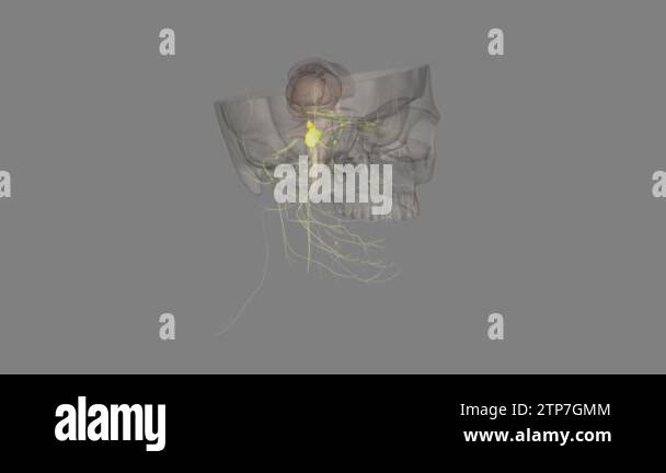 The trigeminal ganglion is located lateral to the cavernous sinus, in a ...