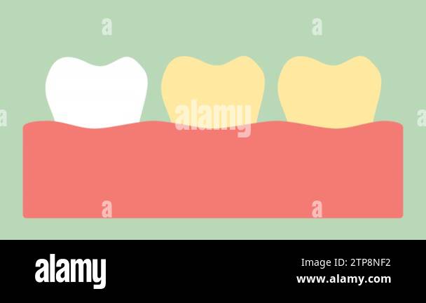 whitening teeth by veneers, yellow to white tooth - dental cartoon ...