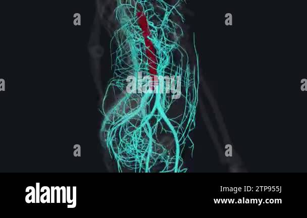 An abdominal aortic aneurysm is an enlarged area in the lower part of ...