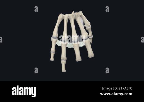 The superficial transverse metacarpal ligament (natatory ligament) is a ...