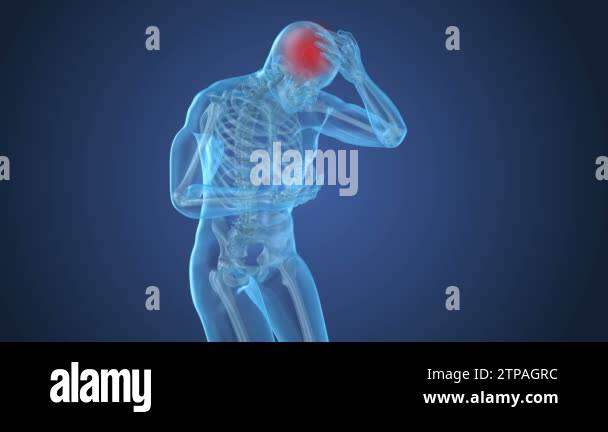 3d man brain head pain Stock Videos & Footage - HD and 4K Video Clips ...