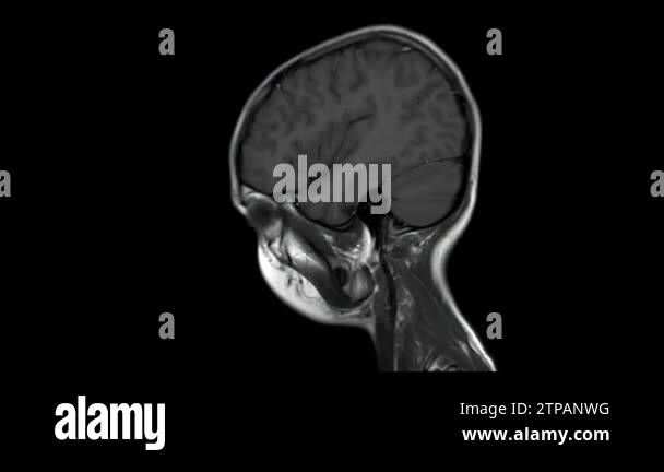 Magnetic resonance imaging(MRI) brain scan of a healthy 10 year old boy ...