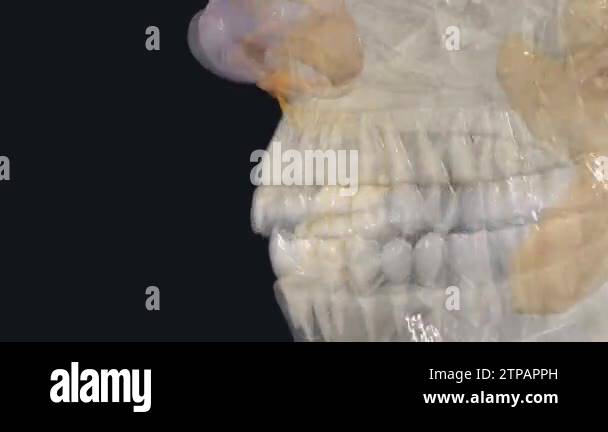 The buccal fat pad, also known as Bichat's fat pad Stock Video Footage ...