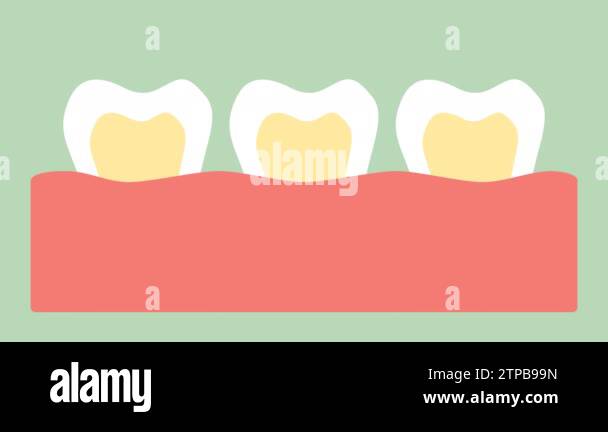 stages of tooth decay or dental caries - teeth cartoon vector flat ...