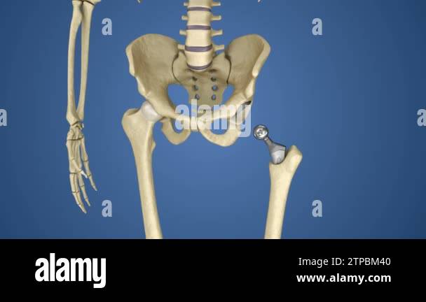 Hip replacement implant installed in the pelvis bone. Medically ...
