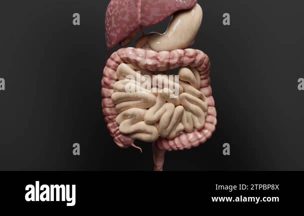 Colorectal cancer, malignant tumor in intestine, Endoscope inside ...