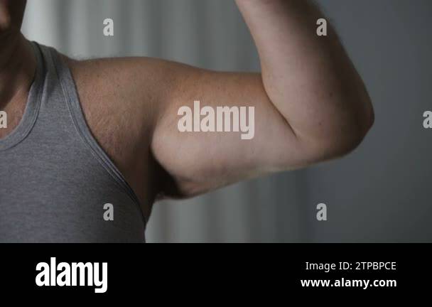 Female plastic surgeon marking line on obese male arm loose skin ...