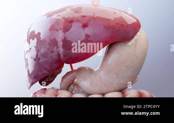 Digestive Organ Liver Cancer, Hepatitis cirrhosis malignant tumor ...