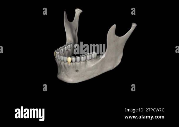 The mandibular canine is the tooth located distally from both ...