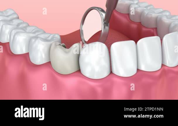 Teeth with caries inspection. Medically accurate tooth 3D animation ...